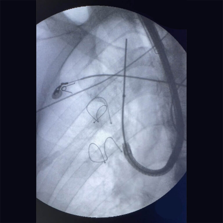 FreeFlow® Coil #2 System - Free Flow Medical